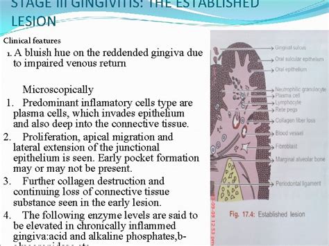 Stages And Clinical Features Of Gingivitis Content Introduction