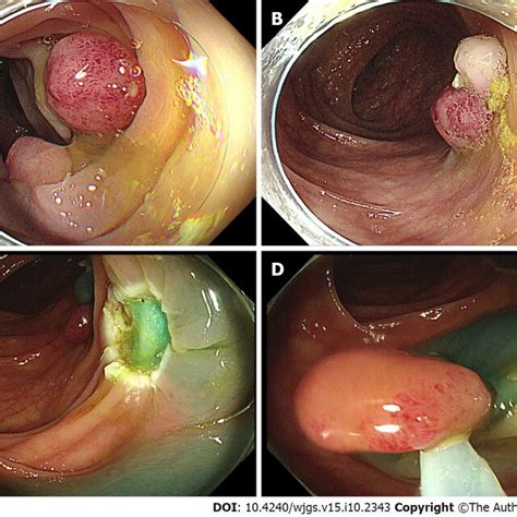 Clinical Findings During Colonoscopy A And B The First Colonoscopy