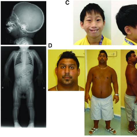 Physical Mutations In Humans