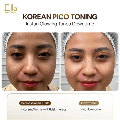 Pico Laser Solusi Cepat Untuk Kulit Sempurna Bebas Noda Ella Skin Care