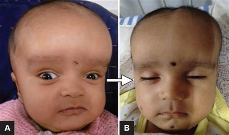 Dandy Walker Syndrome Management At Acharya Vinoba Bhave Rural