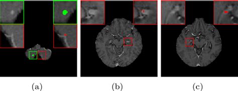 Figure 5 From Deep Learning For Brain Metastasis Detection And Segmentation In Longitudinal Mri
