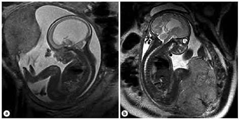 Current Diagnostic Counseling And Treatment Options In Non Severe And