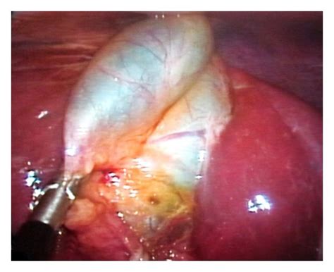 Laparoscopic Image Of Duplicated Gallbladder Download Scientific Diagram