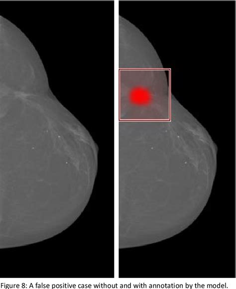 Figure 8 From A Two Stage Mammography Classification Model Using