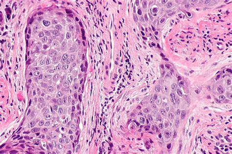Squamous Cell Carcinoma Of The Head And Neck Libre Pathology