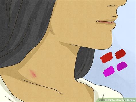 How To Spot A Hickey 8 Telltale Signs