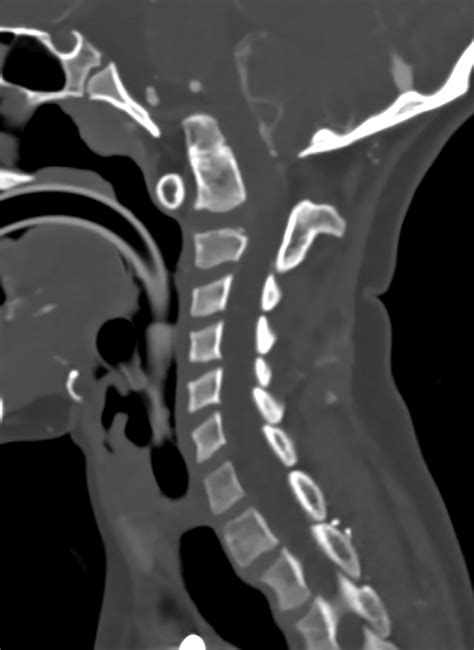 Case 2 Sagittal Cervical Ct Scan Demonstrating Severe Basilar Download Scientific Diagram