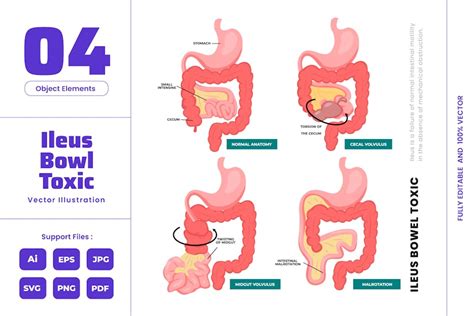 Ileus Bowel Toxic Human Internal Organ Disease Objects Ft Ileus