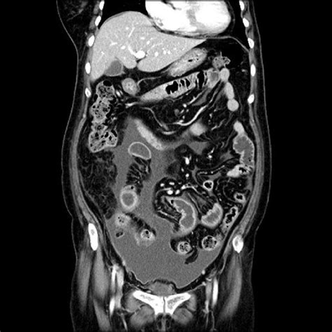 Colonoscopic Findings Of The Orifice Of Appendix A Colonoscopy