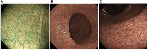 Predicting Histological Healing And Recurrence In Ulcerative Colitis By