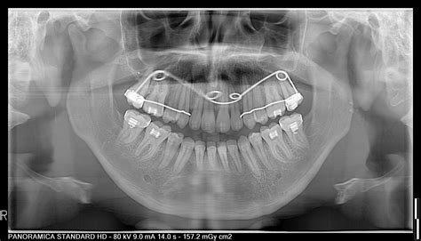 Micrognathia R Jawsurgery