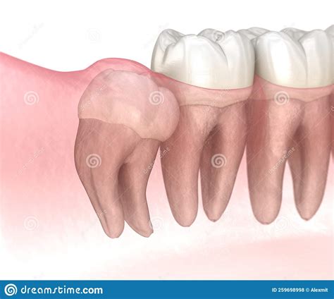 Wisdom Tooth With Impaction At Molar Tooth Medically Accurate Tooth 3d Illustration Royalty