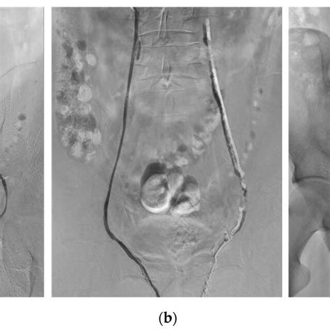 Example Of Typical Bilateral Varicocele Embolization Ve Procedure Download Scientific Diagram