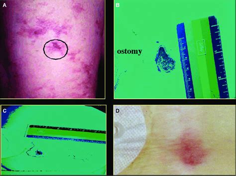 Skin Ulceration In Calciphylaxis Panel A Livedo Reticularis Anterior Download Scientific