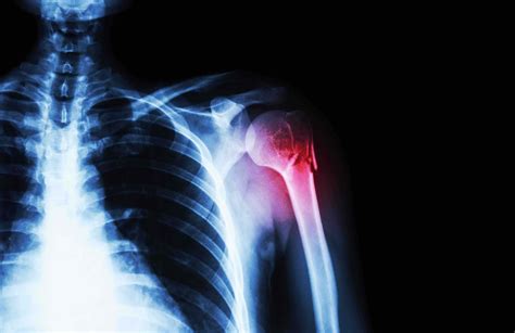 Shoulder ORIF Surgery For Proximal Humerus Fracture AOA Orthopedic Specialists