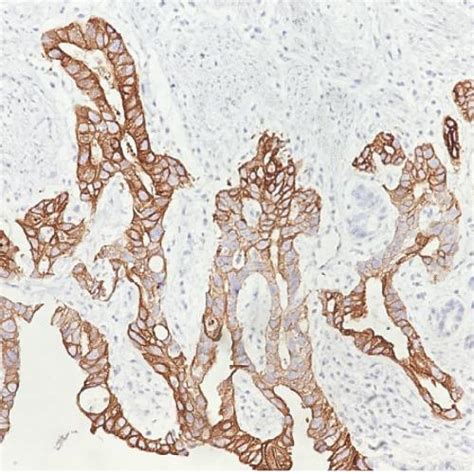 Cancer Diagnostic Antibody And Protein Pathological Diagnostic Reagent And Instrument