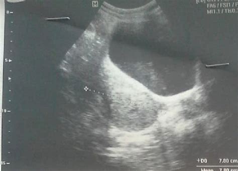 Ultrasonography Of Uterine Inversion Download Scientific Diagram