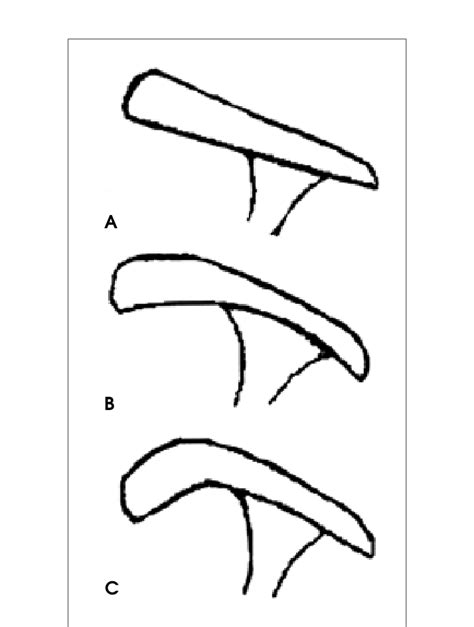 Acromion Shapes Were Classified As Flat A Type 1 Curved B Type 2 Download Scientific