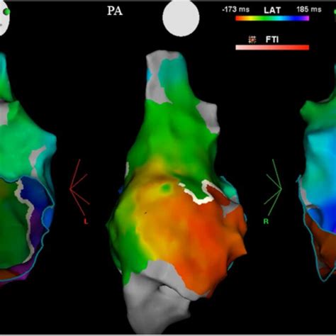 Activation Mapping Of CARTO System The Patient Was Diagnosed With