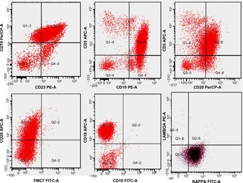 Flow Cytometric Analysis Of Pb Sample Of Case 1 Revealed Clonal B Cells