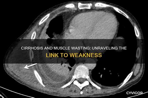 Cirrhosis And Muscle Wasting Unraveling The Link To Weakness Cyvigor