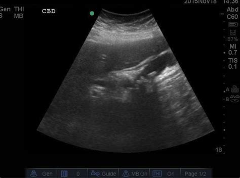 Better Than A Shotgun Approach To Diagnosis Ultrasound In Cholangitis