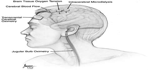 Multimodal Monitoring In The Neurological Intensive Care Uni The Neurologist