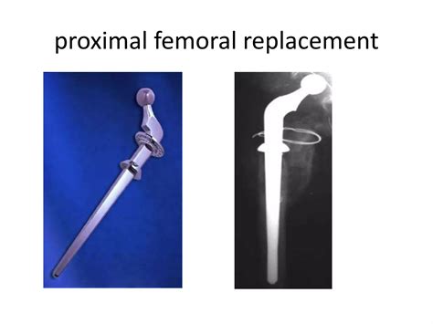 Hip Periprosthetic Fracture Pptx