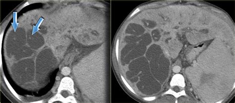 Todani Classification Of Choledochal Radiology Archive Facebook