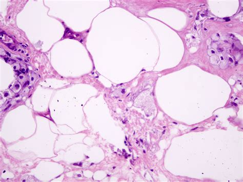 Early Stage Lipodermatosclerosis Centrilobular Necrosis And Ghost Download Scientific Diagram