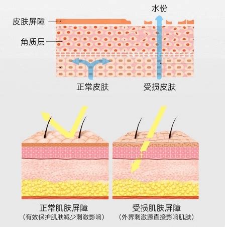 皮肤屏障受损有炎症怎么办 伊的家