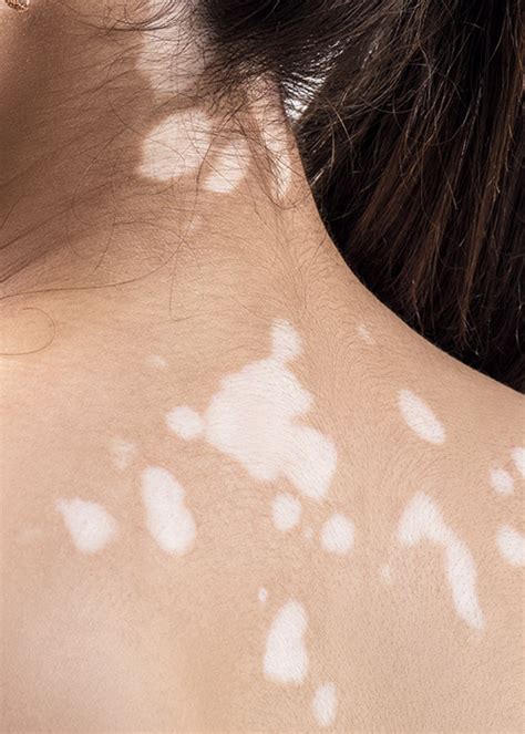 피부질환진료 Bf작은별피부과