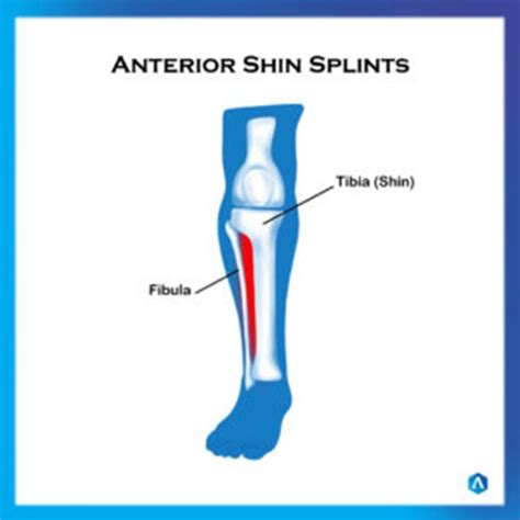 Shin Splints Crown Medical Orthotics