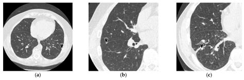 What Do Lung Nodules Look Like On Ct Scan Ct Scan Machine