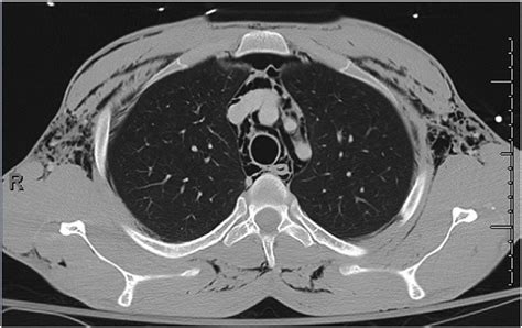 Ct Chest Revealing Subcutaneous Emphysema And Pneumomediastinum Download Scientific Diagram