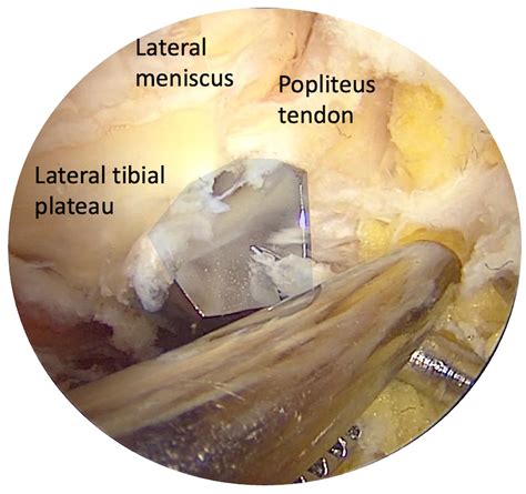 Arthroscopic‐assisted Tibiofibular‐based Posterolateral Corner Knee