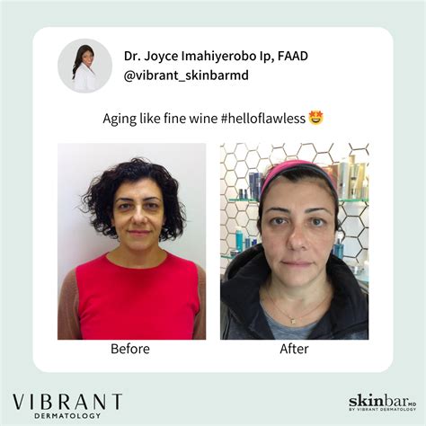 Before And After Botox Dedham Vibrant Dermatology
