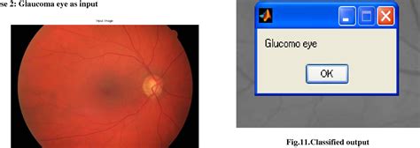 Figure 8 From Feature Extraction Using Contourlet Transform For Glaucomatous Image