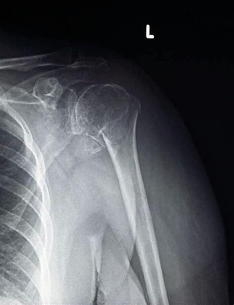 Range Of Motion After Proximal Humerus Fracture At Dianna Wagner Blog