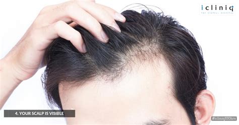 Early Signs You Re Going Bald