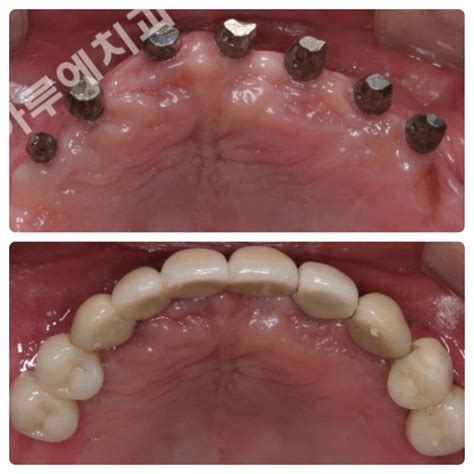 상악전체임플란트 하루에치과