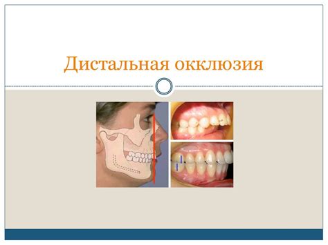 Дистальная окклюзия - презентация онлайн