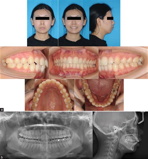 Preformed Intrusion Bulbs On Clear Aligners Facilitate Active Vertical