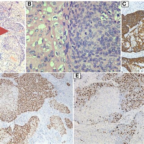 Postoperative Pathology Of The Resected Esophageal Tumor A He Download Scientific Diagram