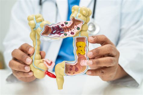 How Do You Know If You Have Colon Cancer Signs And Diagnosis