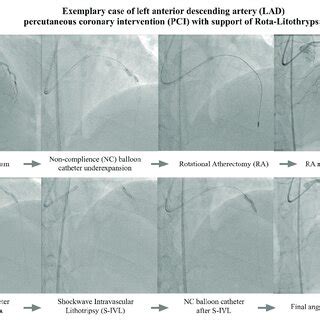 An Exemplary PCI Procedure Download Scientific Diagram