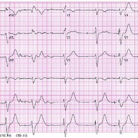 Electrocardiogram After Pacemaker Adjustments Download Scientific