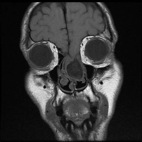 Frontoethmoidal Encephalocoele Pacs
