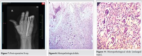 A Rare Case Report Of Giant Cell Tumor In Metacarpal Bone Journal Of Orthopaedic Case Reports